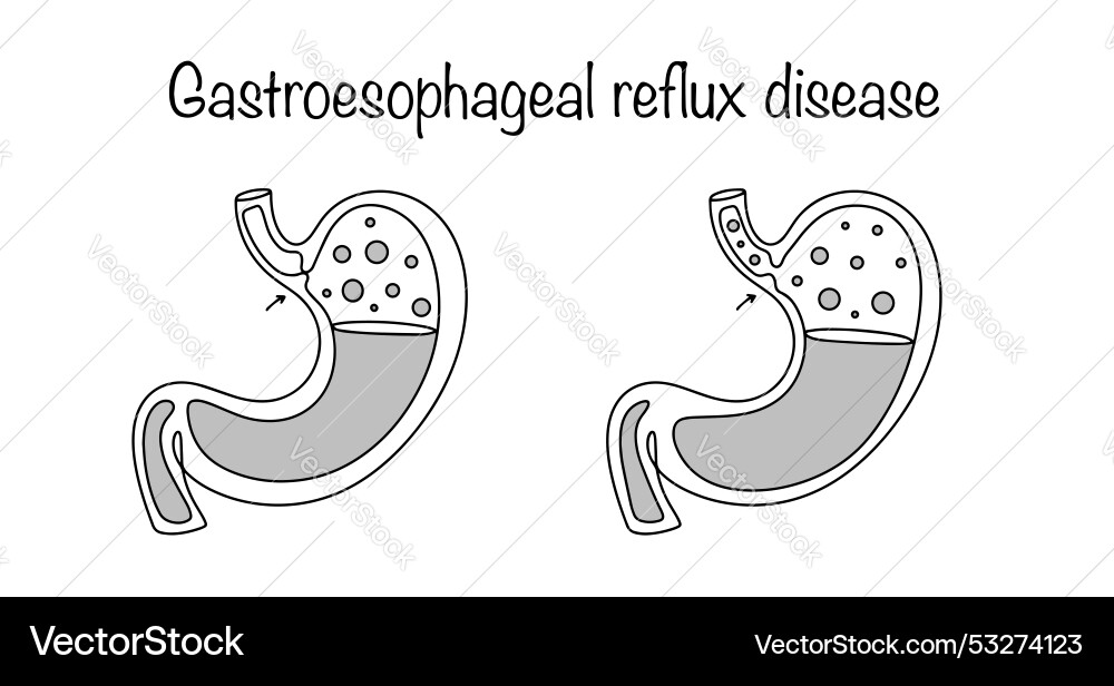 Gastroesophageal reflux disease Royalty Free Vector Image
