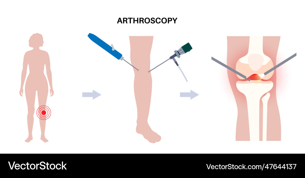 Knee Arthroscopy Procedure Royalty Free Vector Image