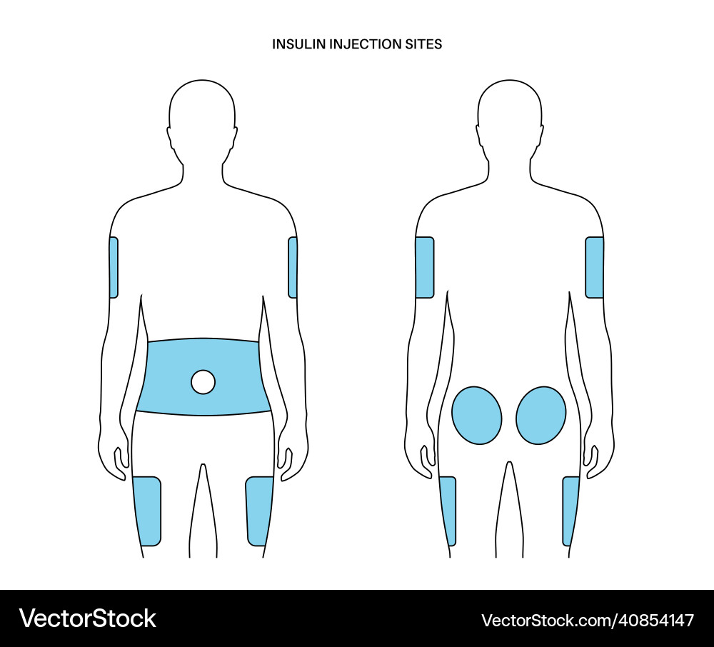 Insulin Injection Sites - Human Anatomy Royalty Free Vector