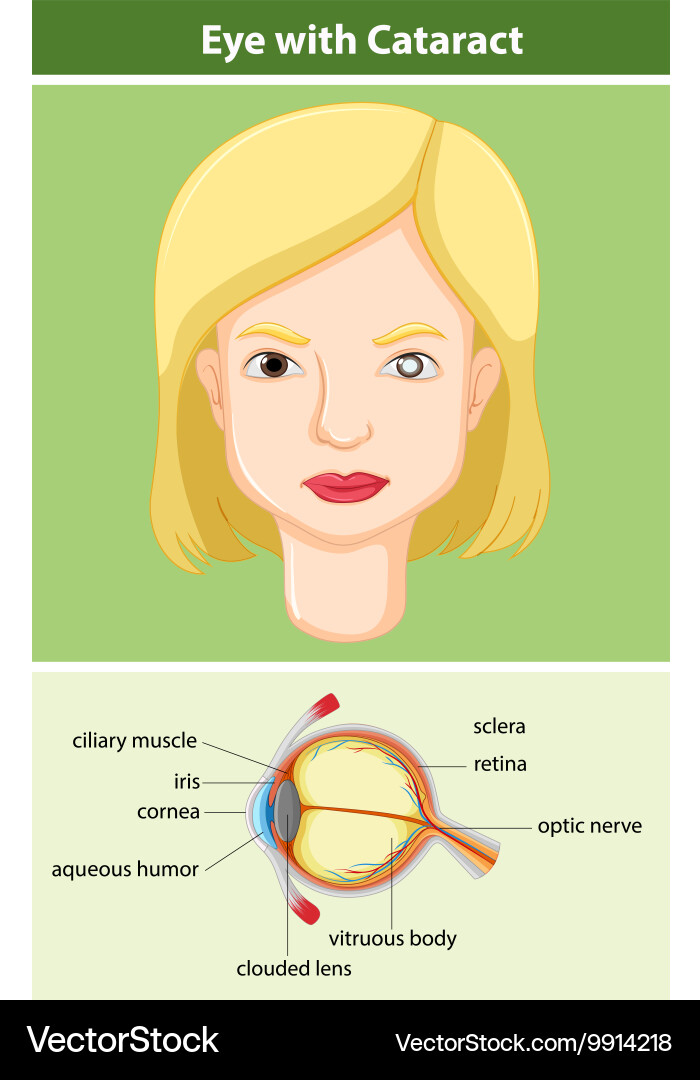 Diagram showing eye with cataract Royalty Free Vector Image