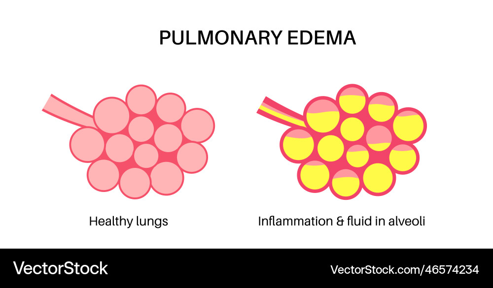 Pulmonary edema disease Royalty Free Vector Image