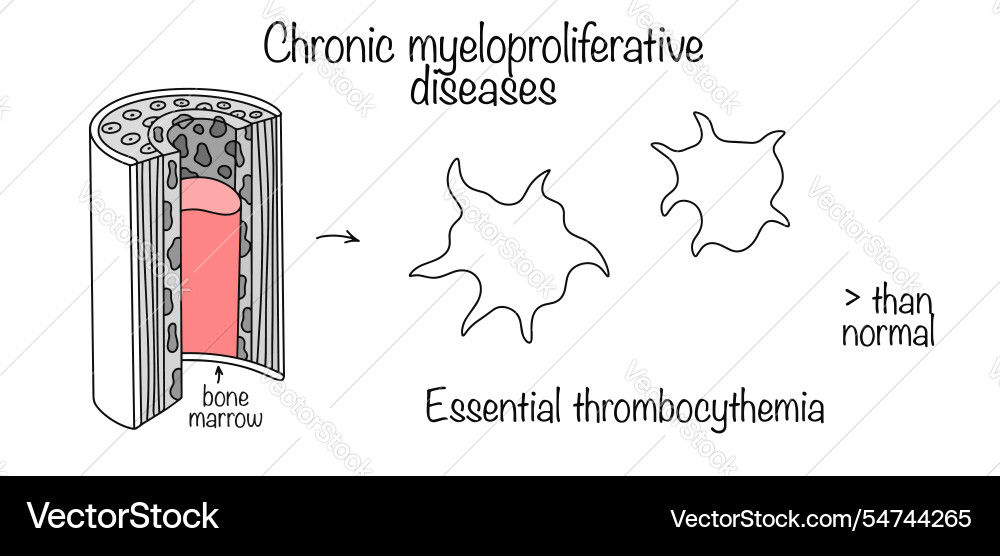 Essential thrombocythemia Royalty Free Vector Image