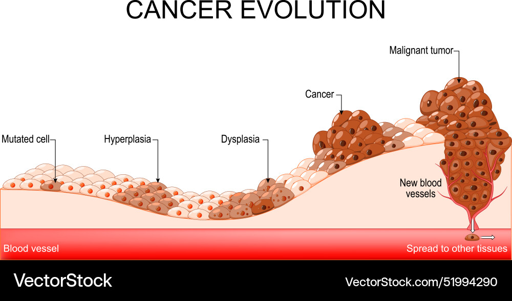 Cancer evolution mutated cell hyperplasia Vector Image