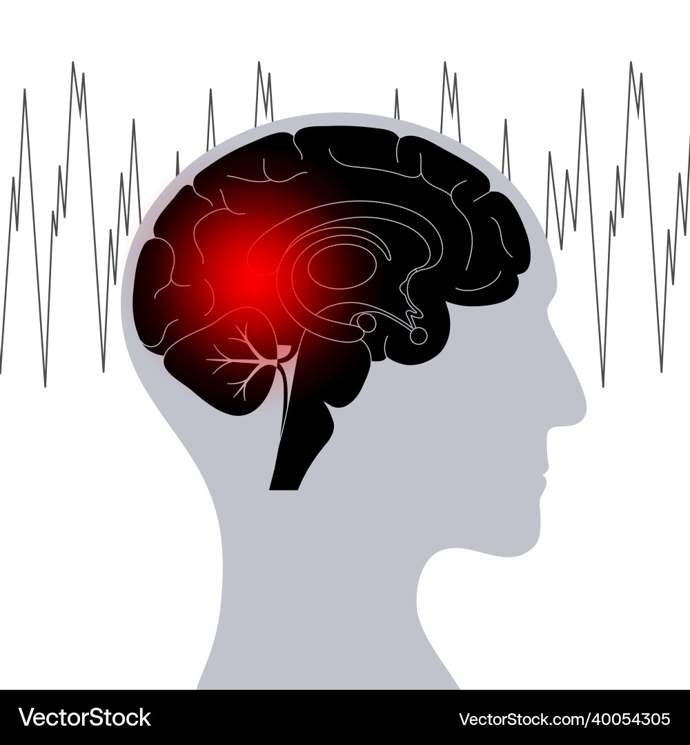 Epilepsy Brain Scan Royalty Free Vector Image - VectorStock