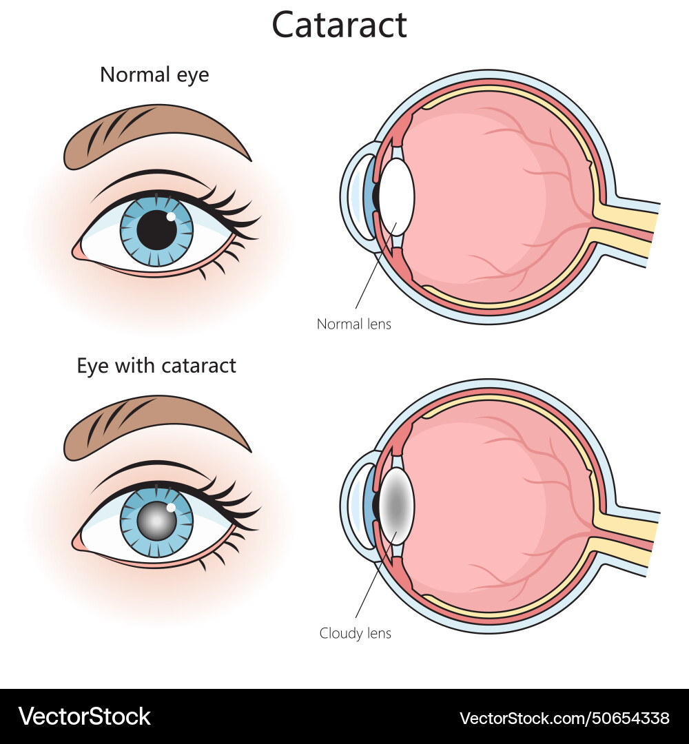 Cataract structure diagram medical science Vector Image