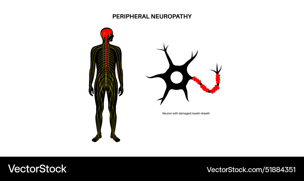 Peripheral neuropathy medical poster Royalty Free Vector