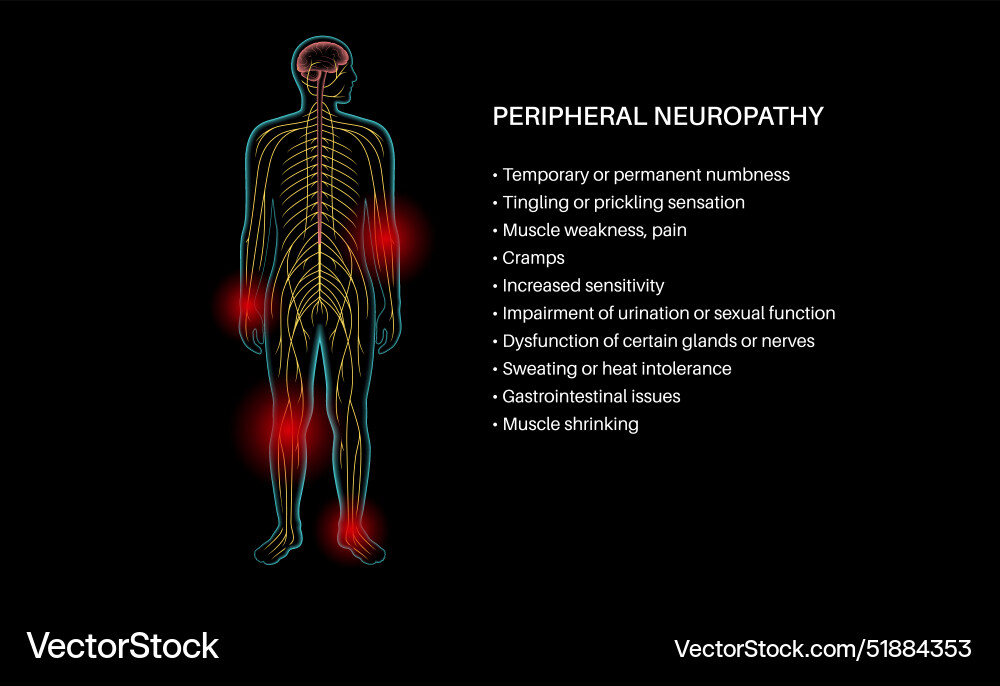 Peripheral neuropathy medical poster Royalty Free Vector