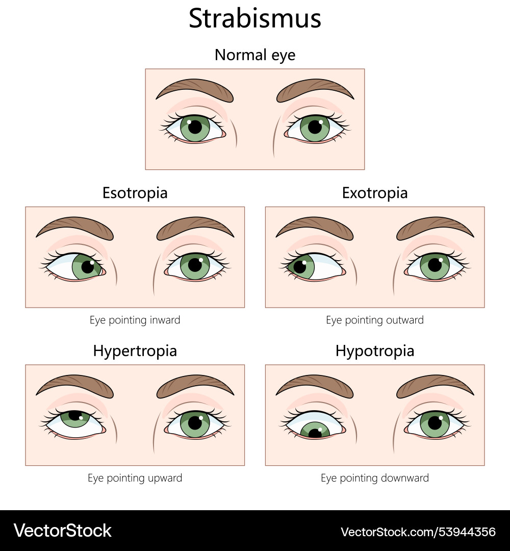 Types of strabismus eye misalignment medical Vector Image