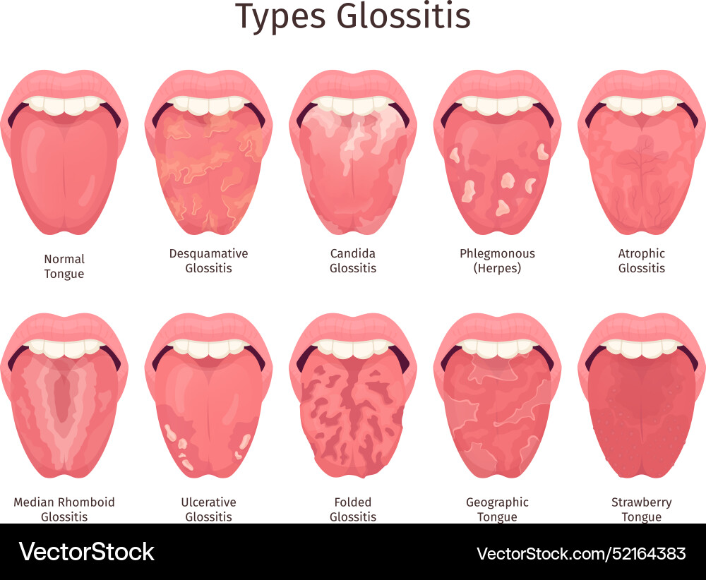 Glossitis and Scarlet Tongue – Royalty-Free Vector | VectorStock