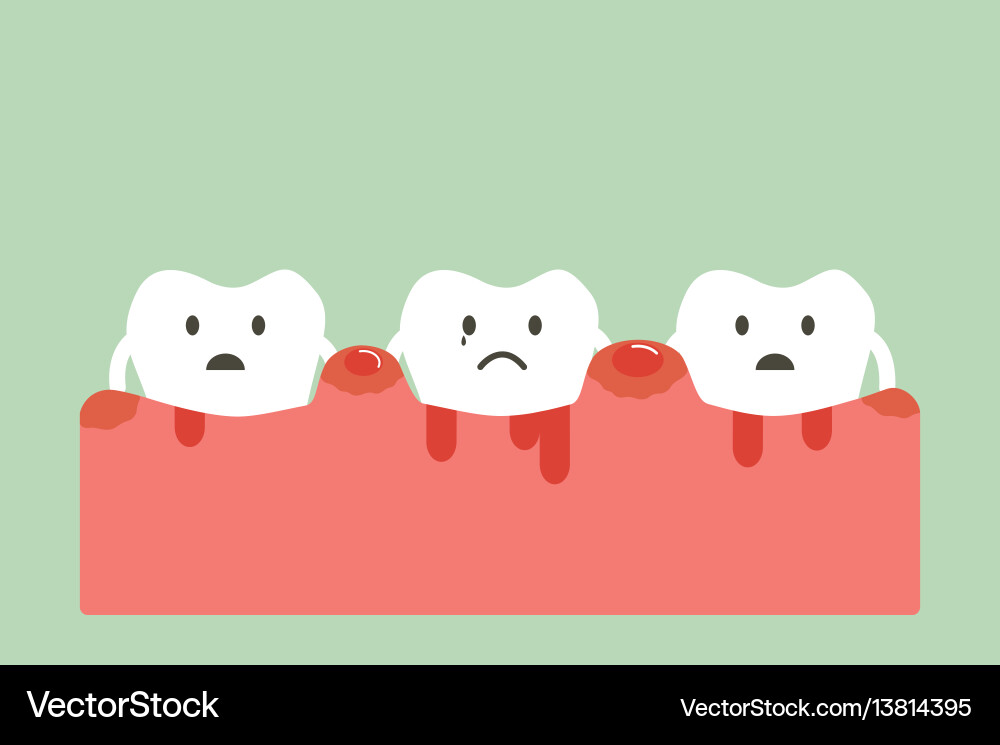 Periodontitis and bleeding Royalty Free Vector Image