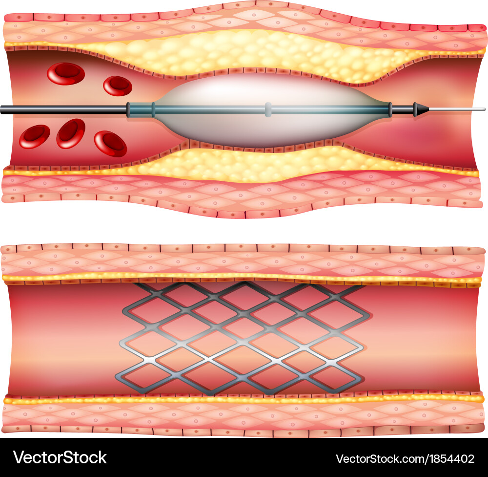 Stent Angioplasty Procedure Royalty Free Vector Image