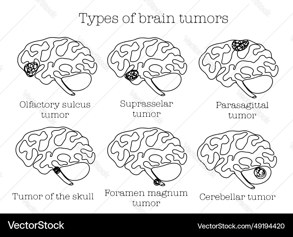 Brain Tumor Types - Single Line Drawing Royalty Free Vector
