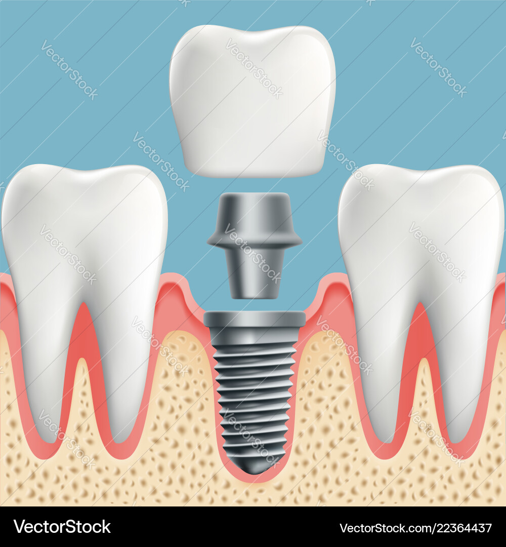 Human teeth and dental implant Royalty Free Vector Image