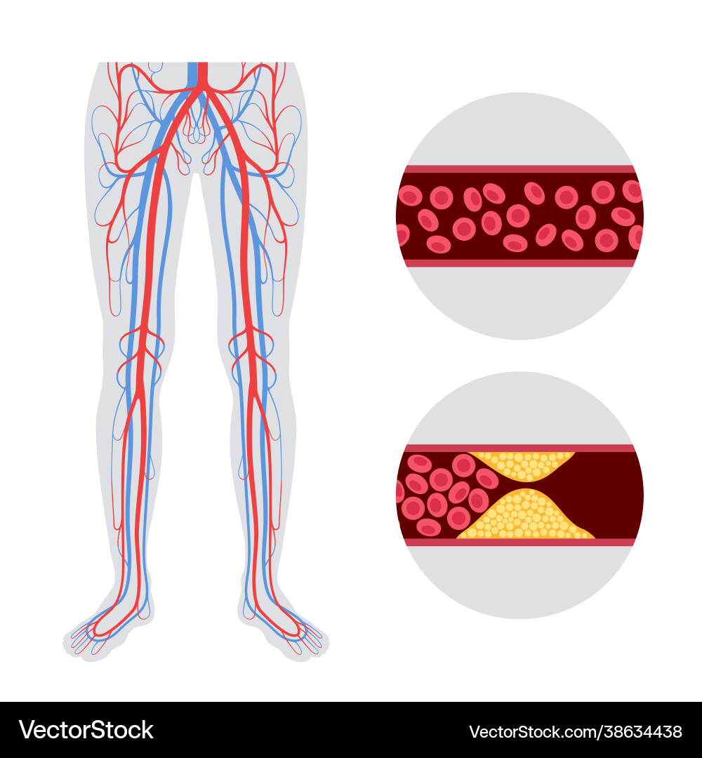 Peripheral artery disease Royalty Free Vector Image