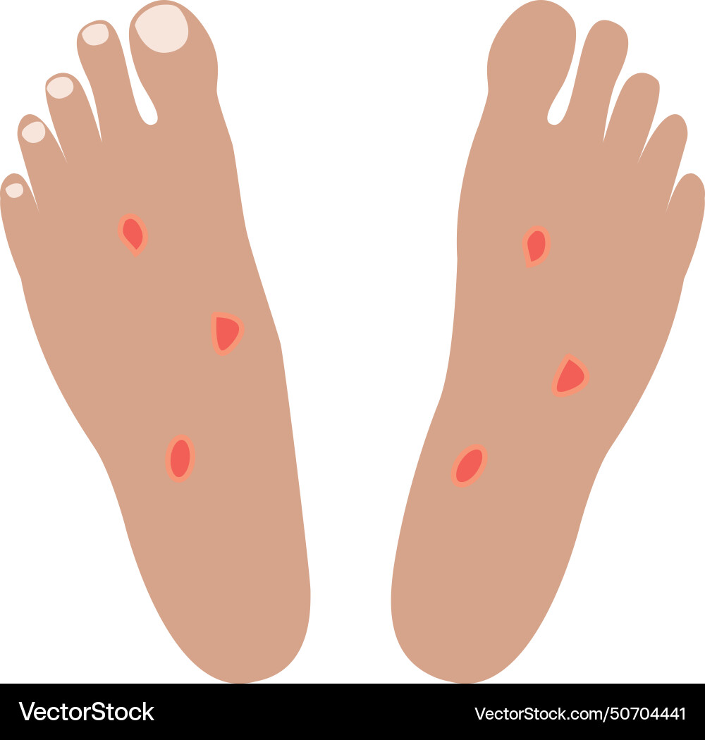 Diabetic foot ulcer and disease Royalty Free Vector Image