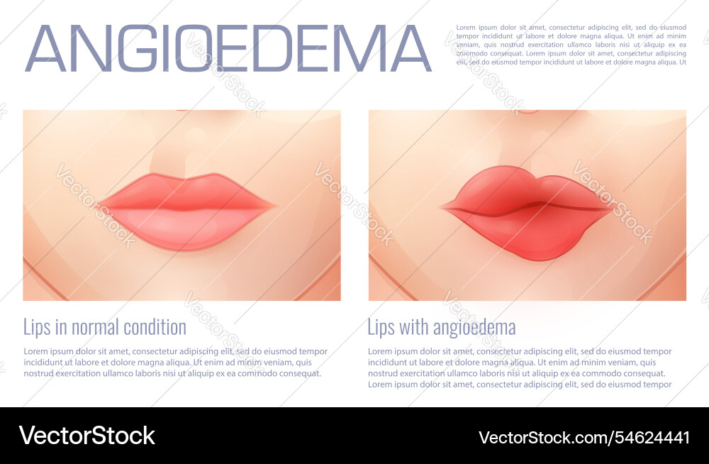 Geschwollene Lippen aus Angioödem oder Ödemschwellungen