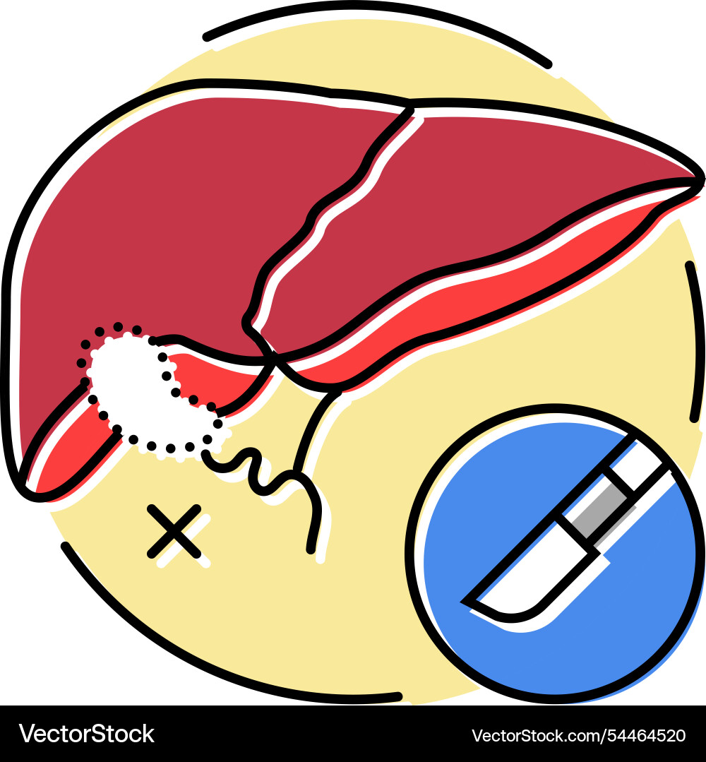 Cholecystectomy surgery color icon Royalty Free Vector Image