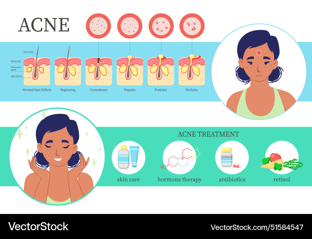 Acne flat face skin treatment infographic Vector Image