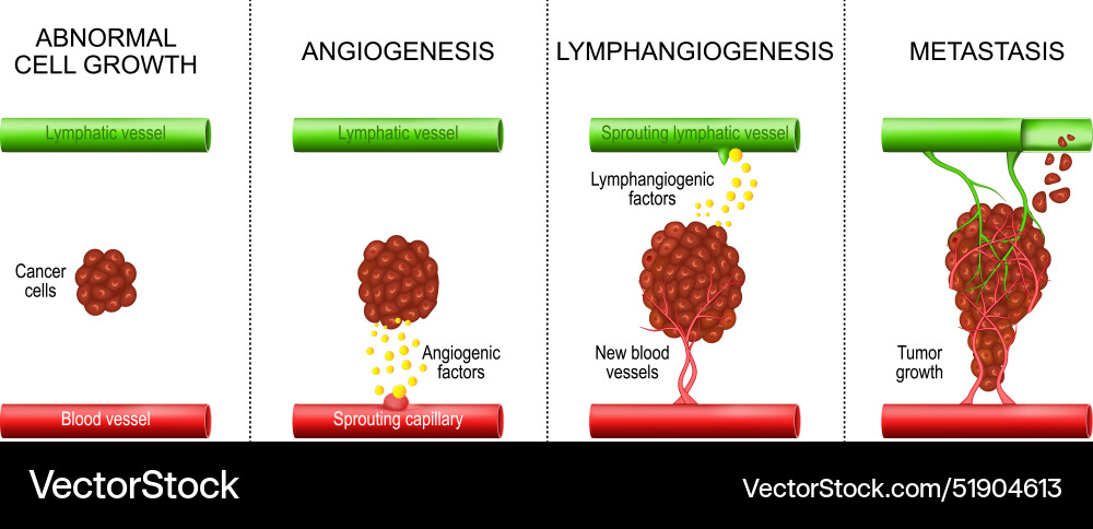 Cancer tumor development angiogenesis Royalty Free Vector