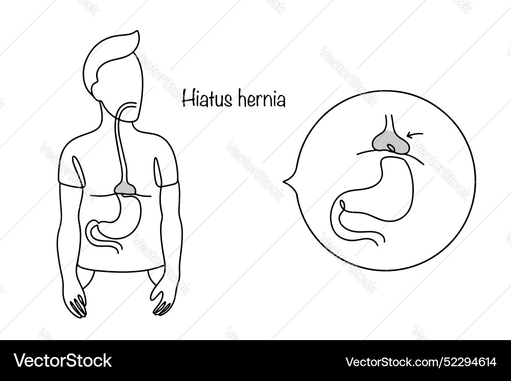 Hernia Hiatal Acid Reflux Symptoms Hiatus Diaphragm Anatomy Cancer ...
