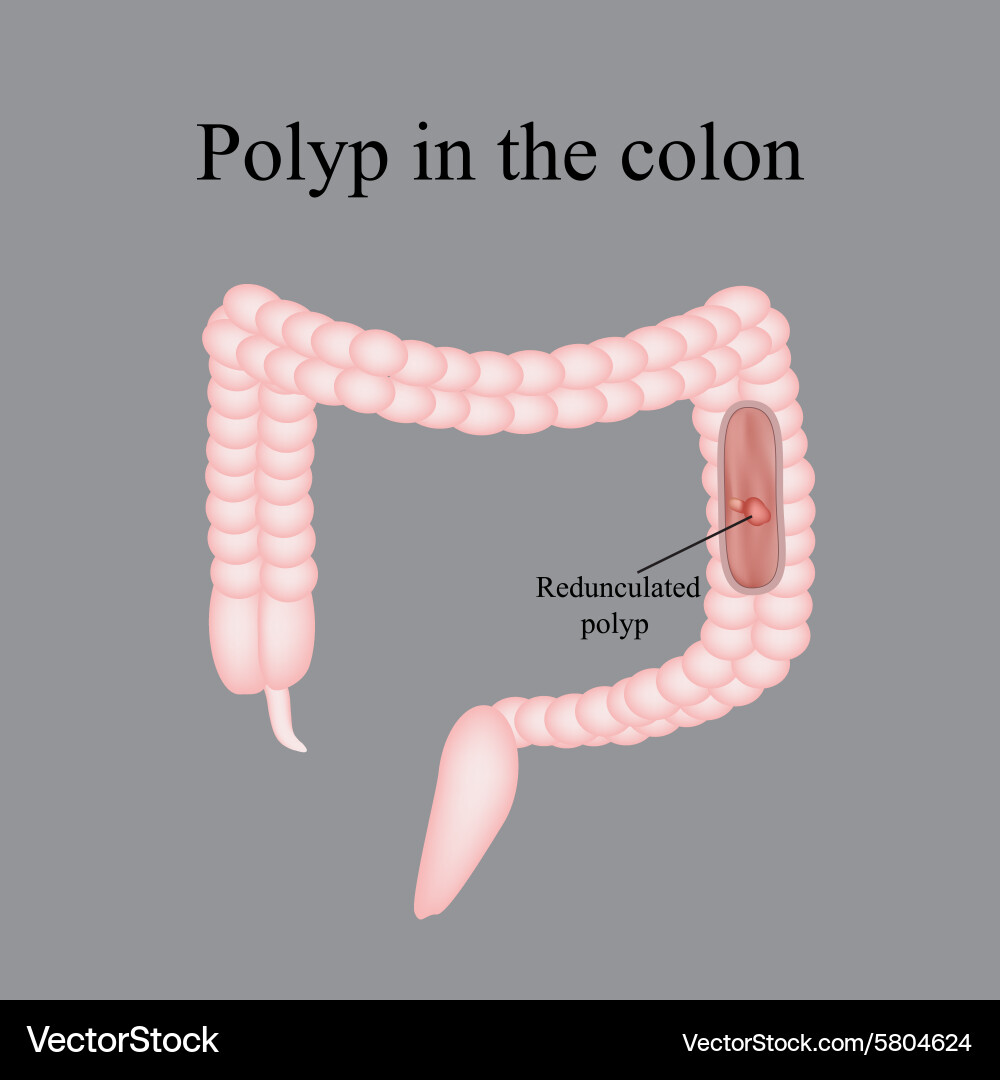 Colon Polyp – Medical Anatomy Royalty Free Vector
