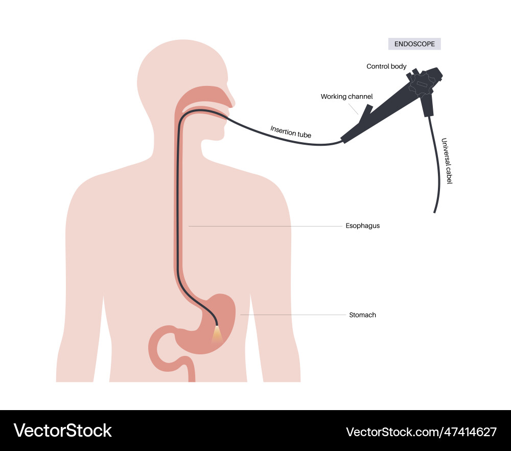 Gastroscopy Procedure – Endoscopy – Royalty-Free Vector | VectorStock