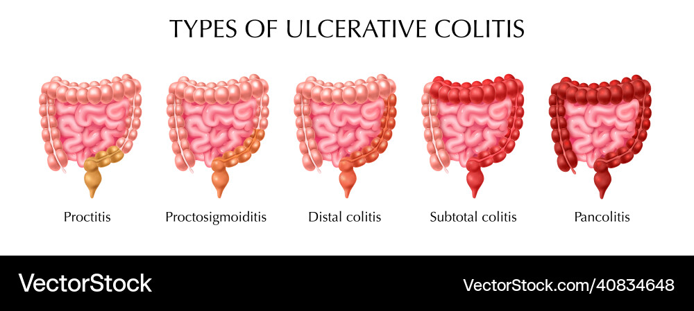 Ulcerative colitis types infographics Royalty Free Vector