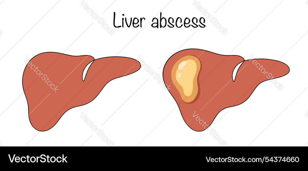 Lebewesen Abszess Lizenzfreies Vektorbild - VectorStock