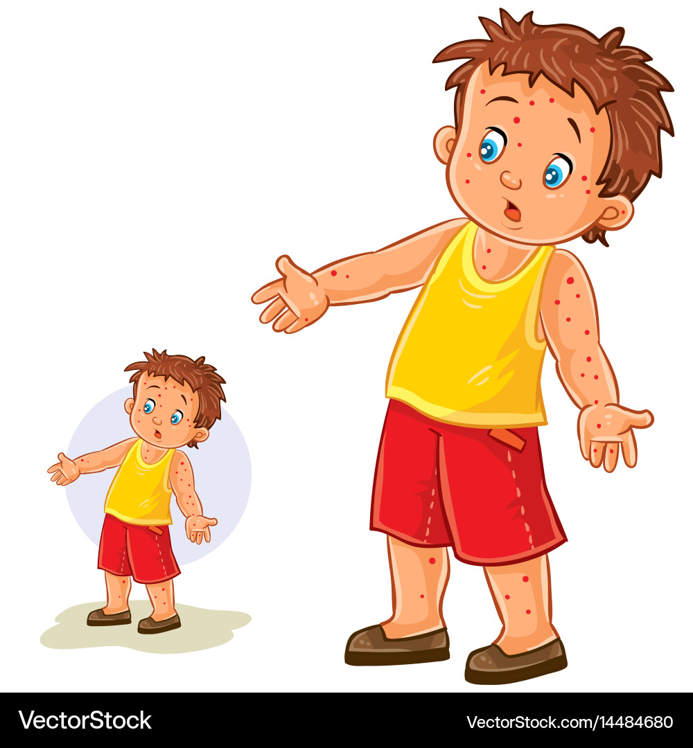Little boy with a rash on his hands Royalty Free Vector
