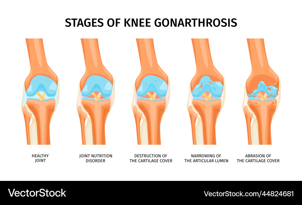 Gonarthrosis realistic infographics Royalty Free Vector