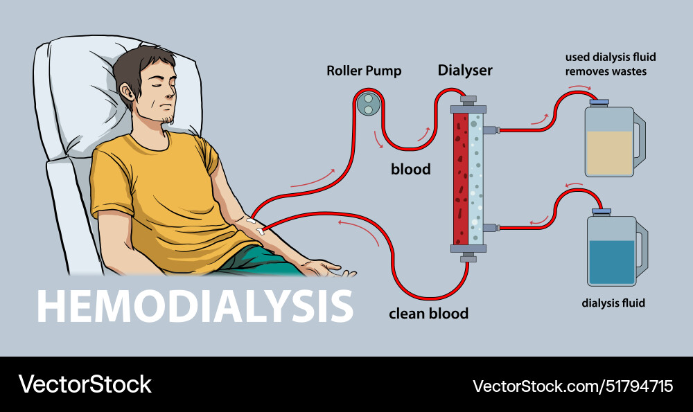 Hemodialysis diagram Royalty Free Vector Image