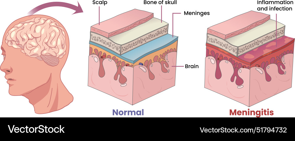 Meningitis inflammation Royalty Free Vector Image