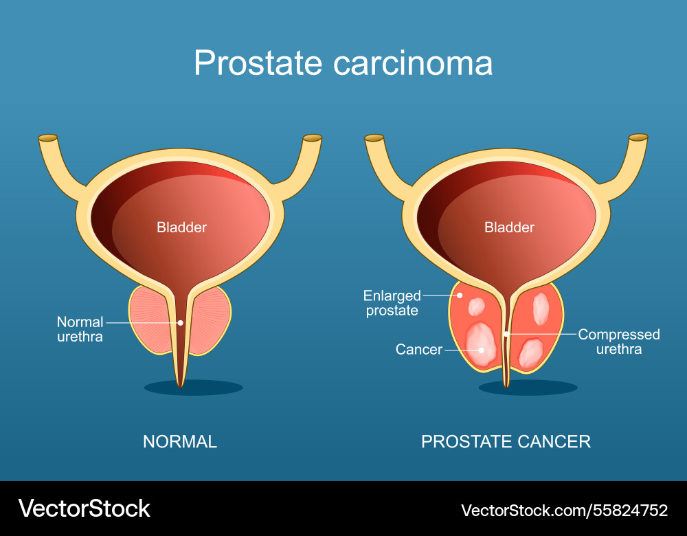 Prostate Adenocarcinoma Anatomy Royalty Free Vector Image