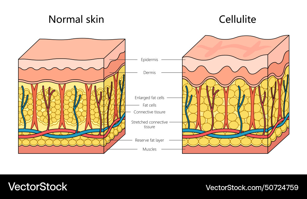 Cellulite skin structure diagram medical science Vector Image