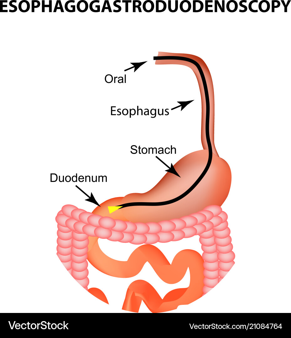 Esophagogastroduodenoscopy (EGD) – Royalty-Free Vector | VectorStock