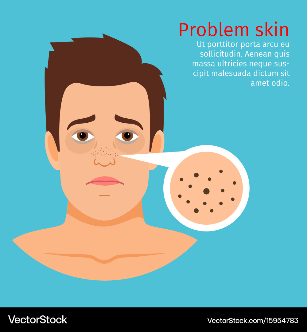 Man face skin problem black dots Royalty Free Vector Image