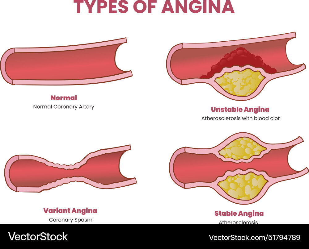 Types of angina Royalty Free Vector Image - VectorStock
