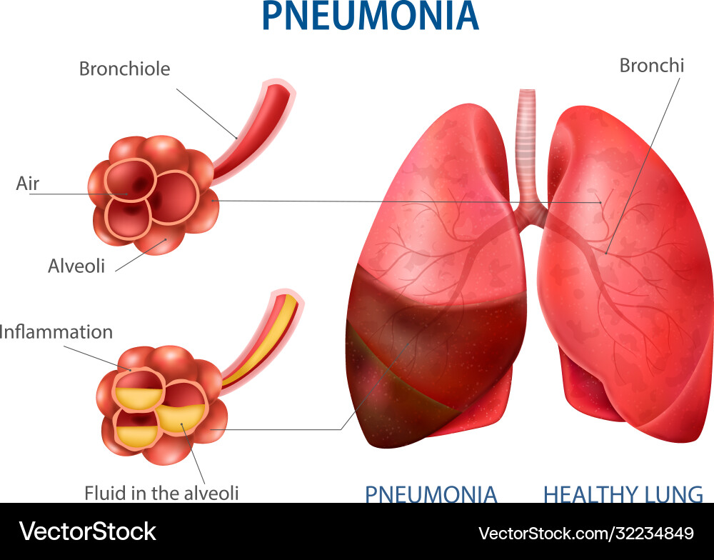 Pneumonia realistic set Royalty Free Vector Image