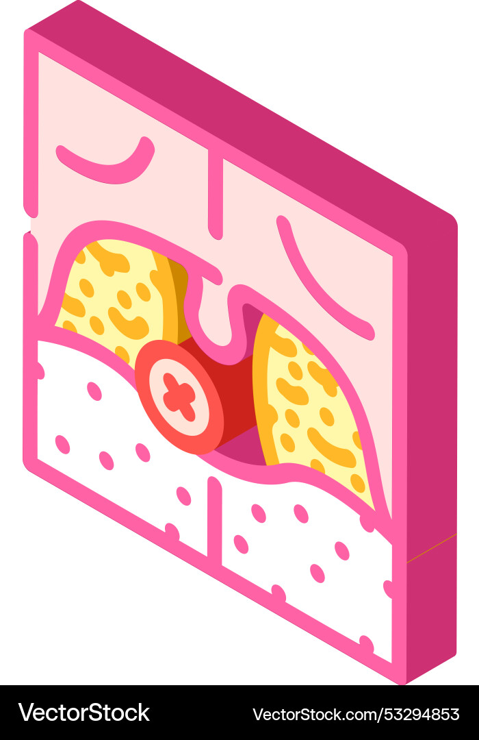 Tonsillectomy surgery isometric icon Royalty Free Vector