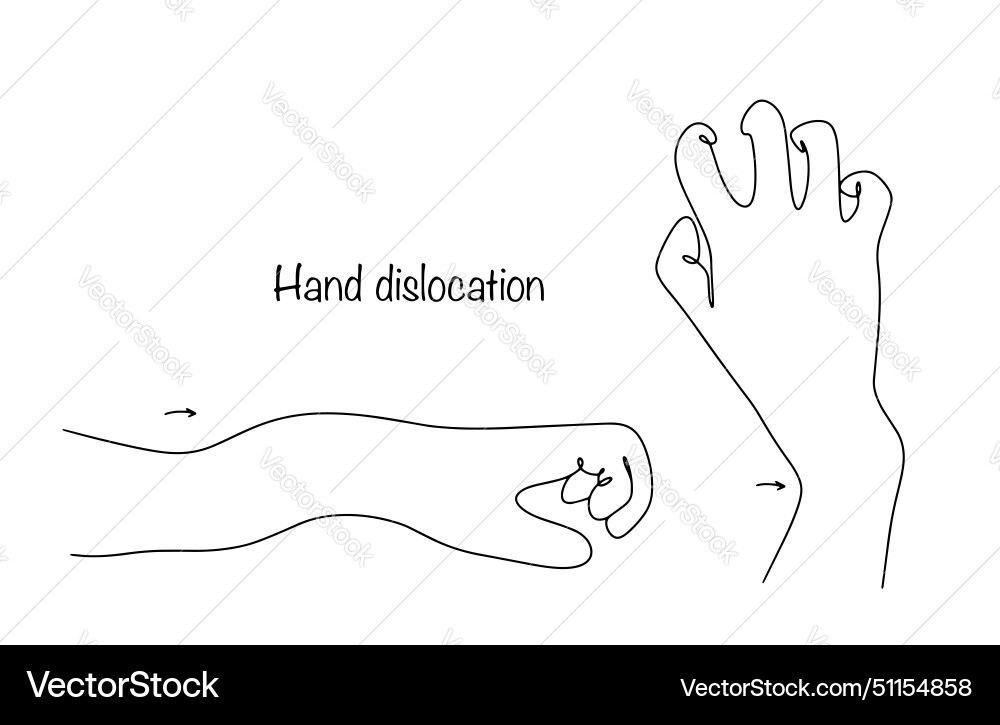 Dislocated wrist Royalty Free Vector Image - VectorStock