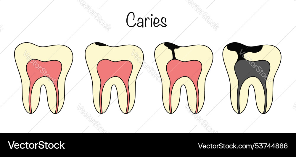 Caries Royalty Free Vector Image - VectorStock