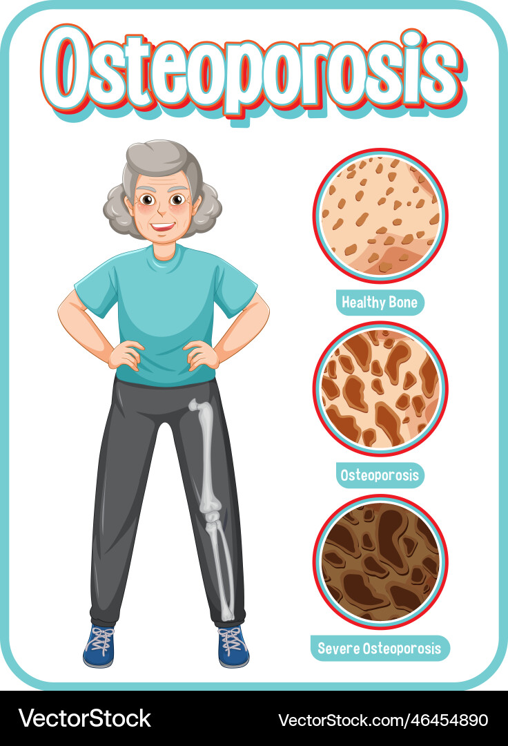 Comparison of normal bone Royalty Free Vector Image