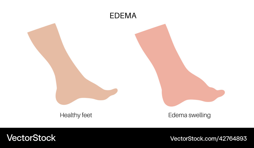 Edema of feet Royalty Free Vector Image - VectorStock