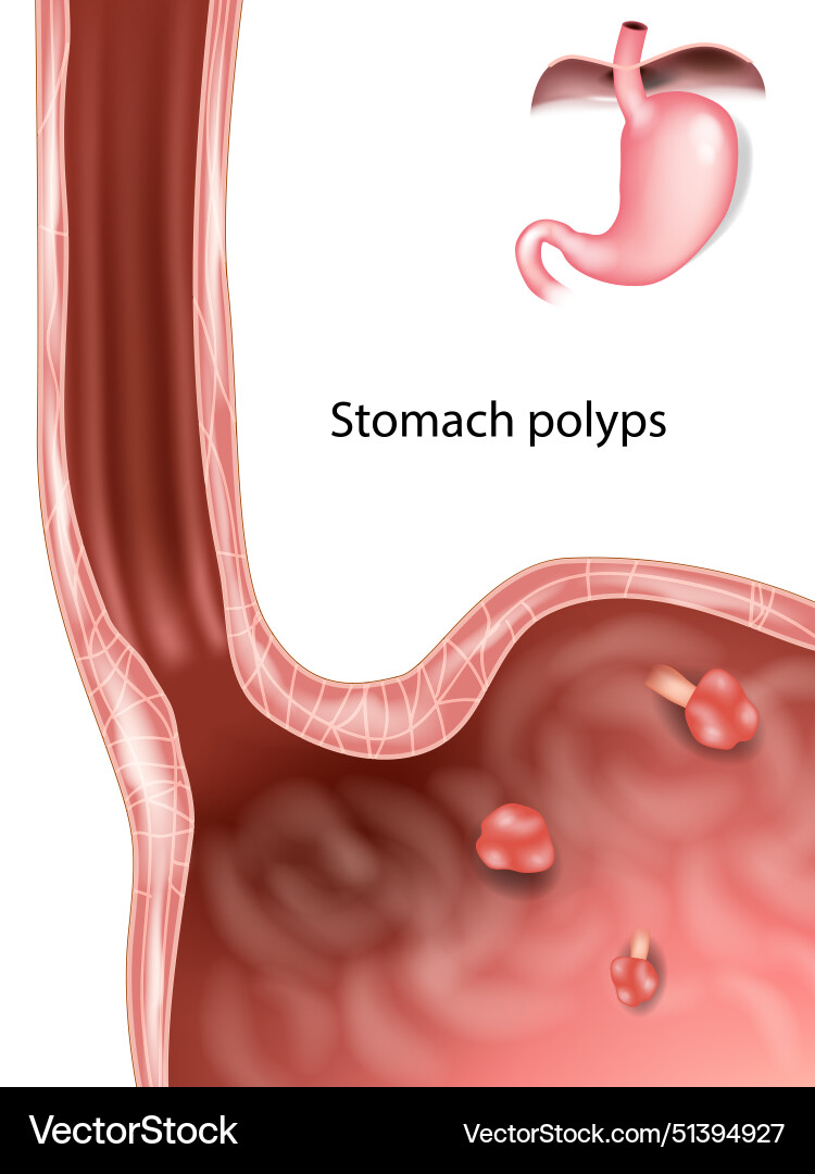Polyps in stomach gastric polyp medical Royalty Free Vector