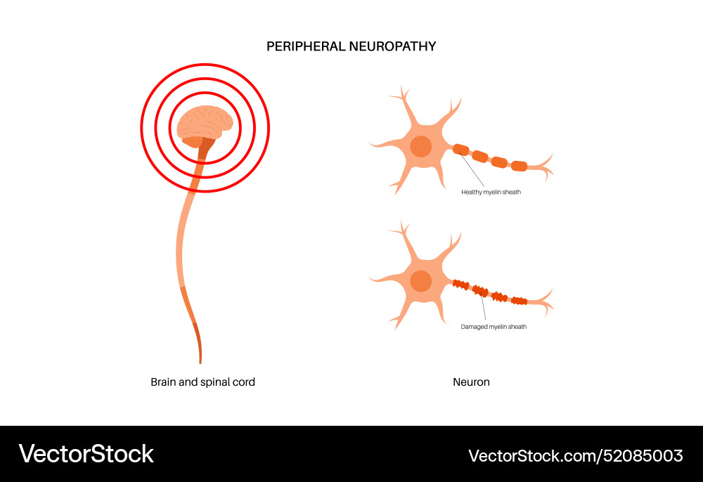 Peripheral neuropathy medical poster Royalty Free Vector