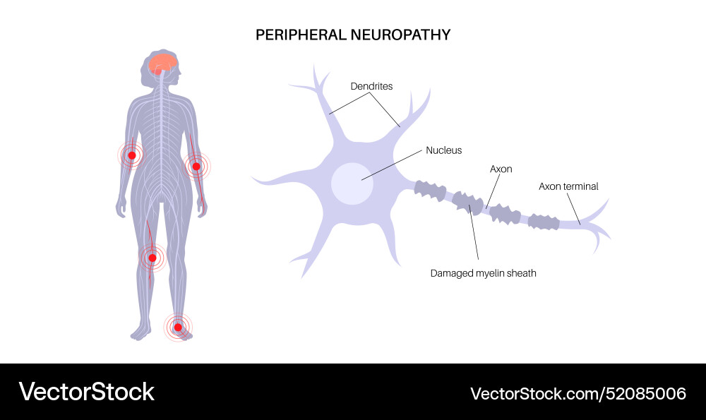 Peripheral neuropathy medical poster Royalty Free Vector