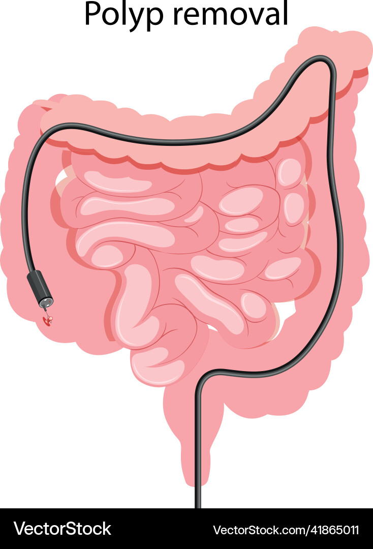 Diagram showing polyp removal Royalty Free Vector Image