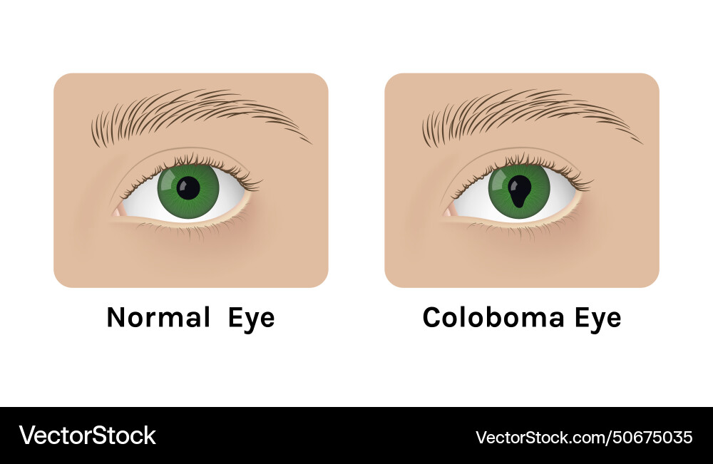 Realistic human normal eyes and with colomba Vector Image