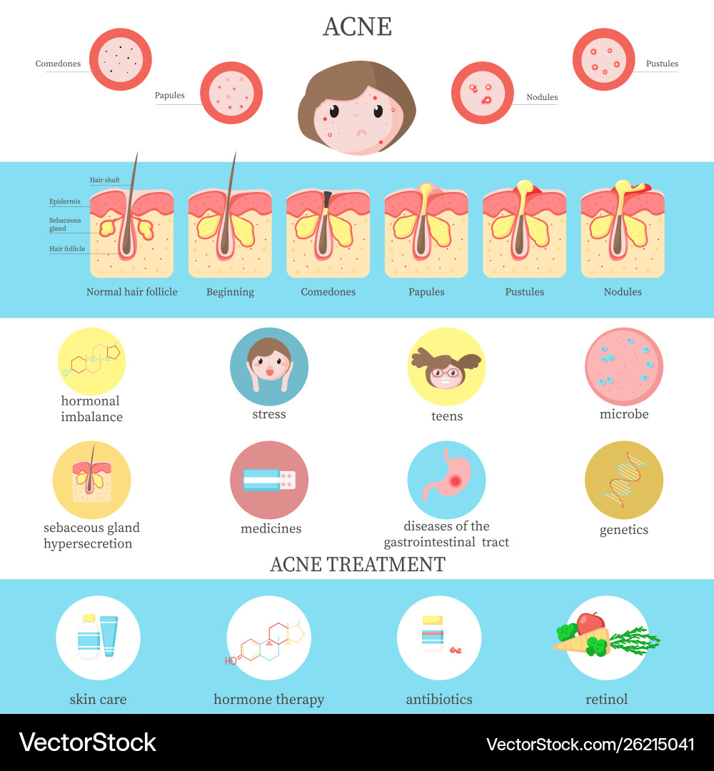 Acne types causes and treatment infographics Vector Image