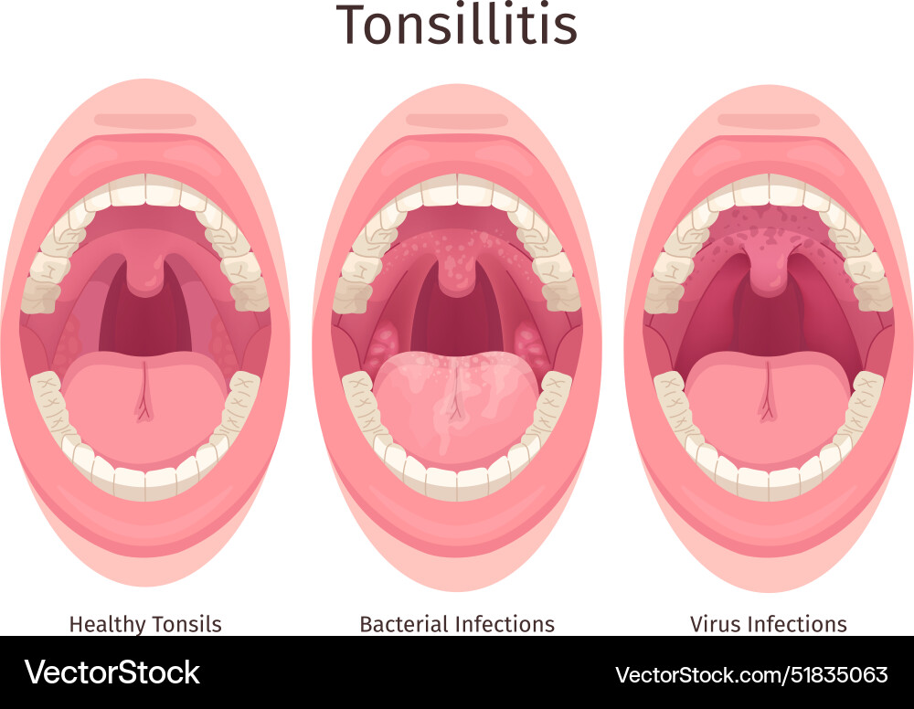 Tonsils human sore throat airways inflammation Vector Image